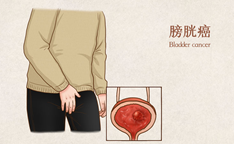 大批患者肿瘤完全消失！加拿大新型光动力疗法TLD-1433治疗膀胱癌疗效积极-出国看病-盛诺一家